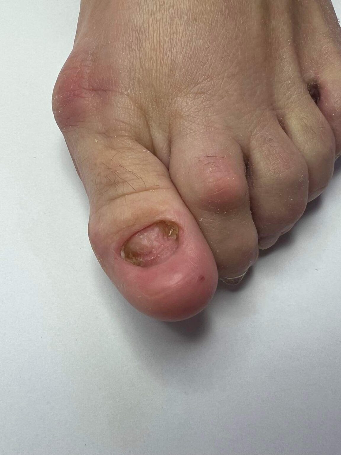 Haluks, czyli paluch koślawy (hallux valgus) » BEAUTY FORUM